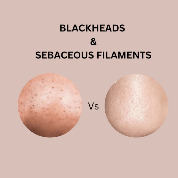 How to Get Rid of Blackheads and Sebaceous Filaments Naturally: A Guid ...